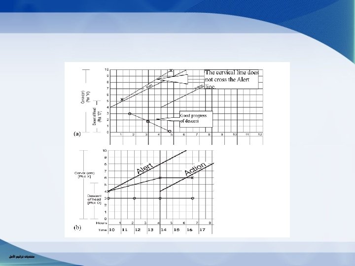 OBSTRUCTED LABOUR By Alaa Gamal Definition Failure of