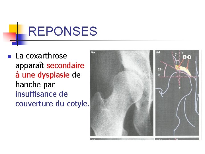 CAS CLINIQUE HANCHE Une femme de 46 ans