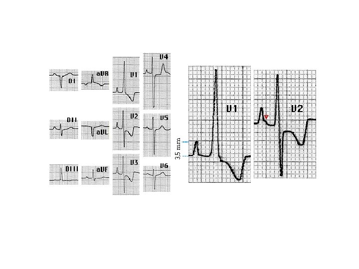 ELECTROCARDIOGRAMA NORMAL RITMO Sinusal Onda P DI DII