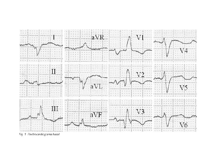 ELECTROCARDIOGRAMA NORMAL RITMO Sinusal Onda P DI DII