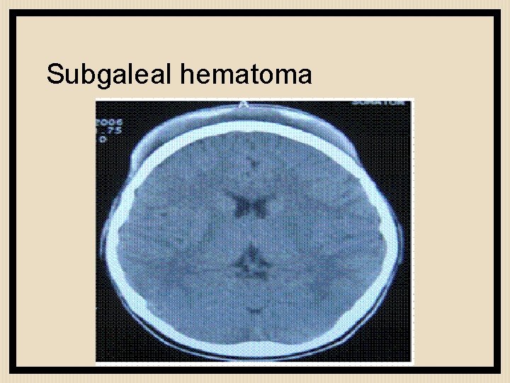 HEAD INJURY Done By Yara khaled yaseen Definition