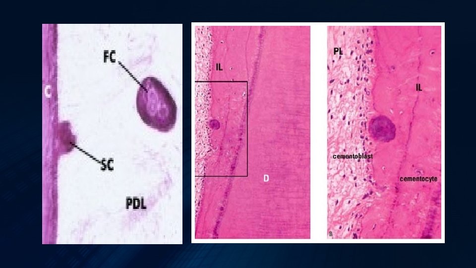 Cementicles Cemental Spurs Concrescence BY IRYNA YAKYMENKO DEN