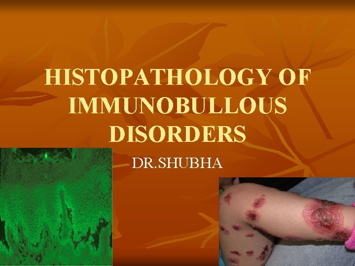 HISTOPATHOLOGY OF IMMUNOBULLOUS DISORDERS DR SHUBHA INTRAEPIDERMAL BULLOUS