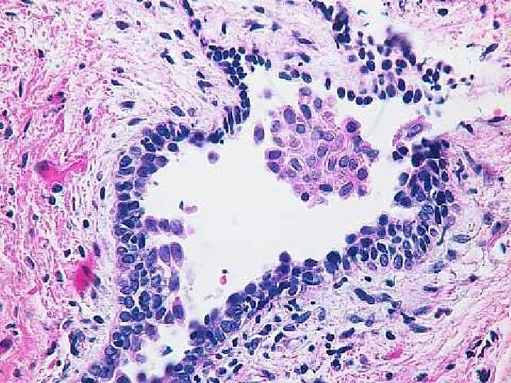 HISTOPATHOLOGY OF IMMUNOBULLOUS DISORDERS DR SHUBHA INTRAEPIDERMAL BULLOUS
