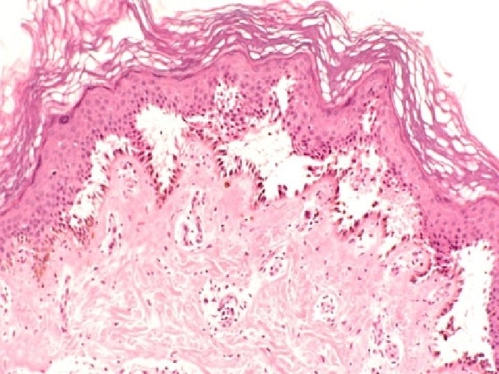 HISTOPATHOLOGY OF IMMUNOBULLOUS DISORDERS DR SHUBHA INTRAEPIDERMAL BULLOUS