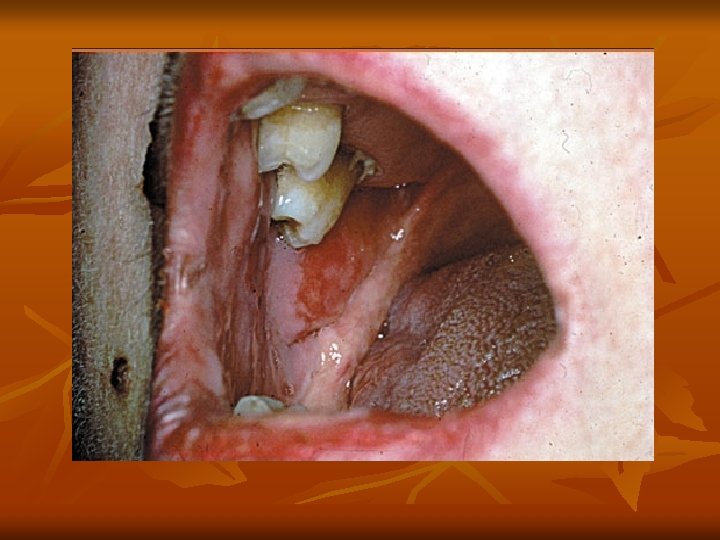 HISTOPATHOLOGY OF IMMUNOBULLOUS DISORDERS DR SHUBHA INTRAEPIDERMAL BULLOUS