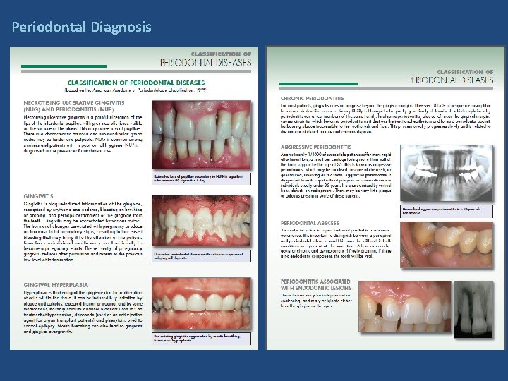 Prescribing for Periodontal Disease Becky Coulter Periodontal Disease