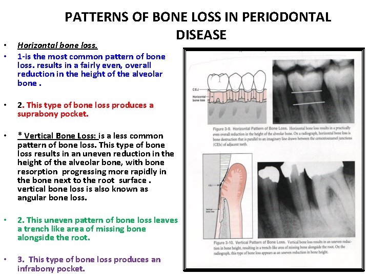 Defense Mechanisms of the Gingiva BONE DESTRUCTION PERIODONTAL