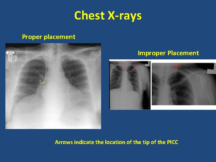 Review of PICC Lines Kelly Mc Cormick RN