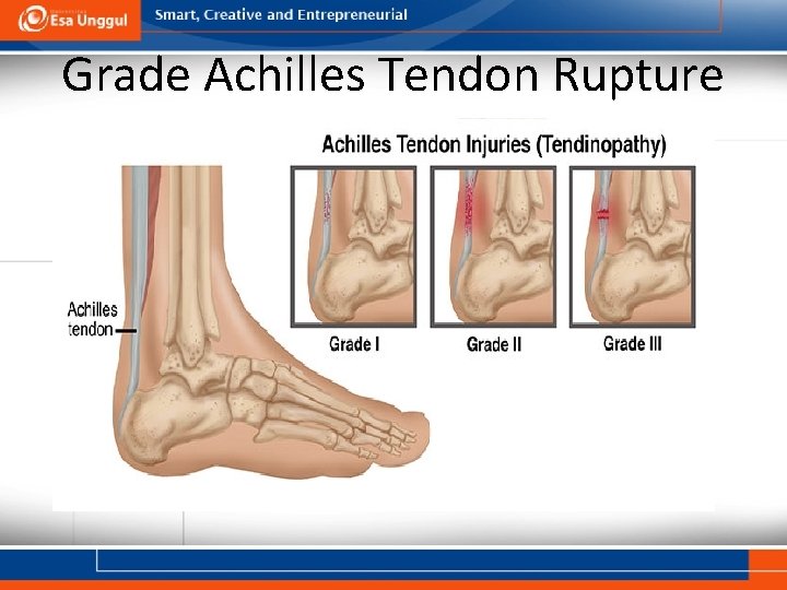 ACHILLES TENDON RUPTURE PERTEMUAN 14 JERRY MARATIS FAKULTAS