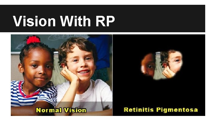 Retinitis Pigmentosa Owen Ferrara Physiological Cause Retinitis Pigmentosa