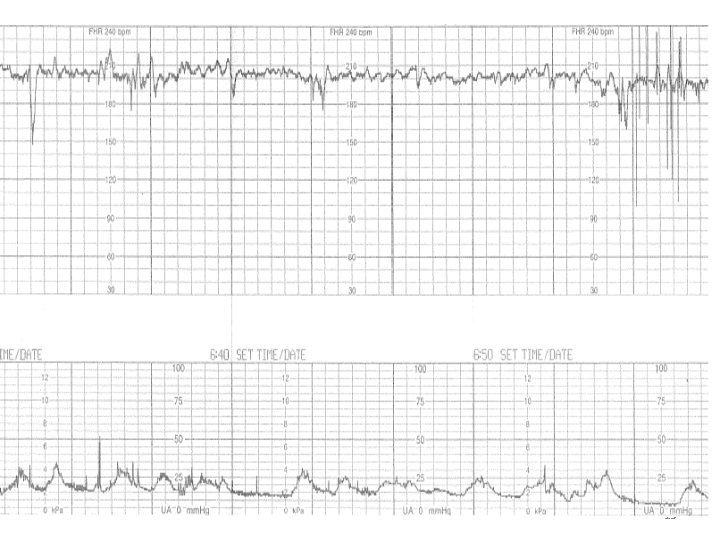 Chapter 16 CTG Dr Areefa Albahri FHR as
