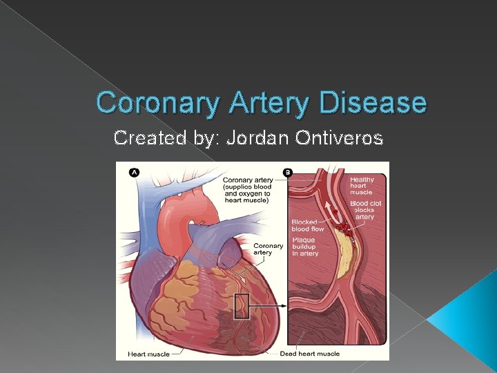 Coronary Artery Disease Created by Jordan Ontiveros How