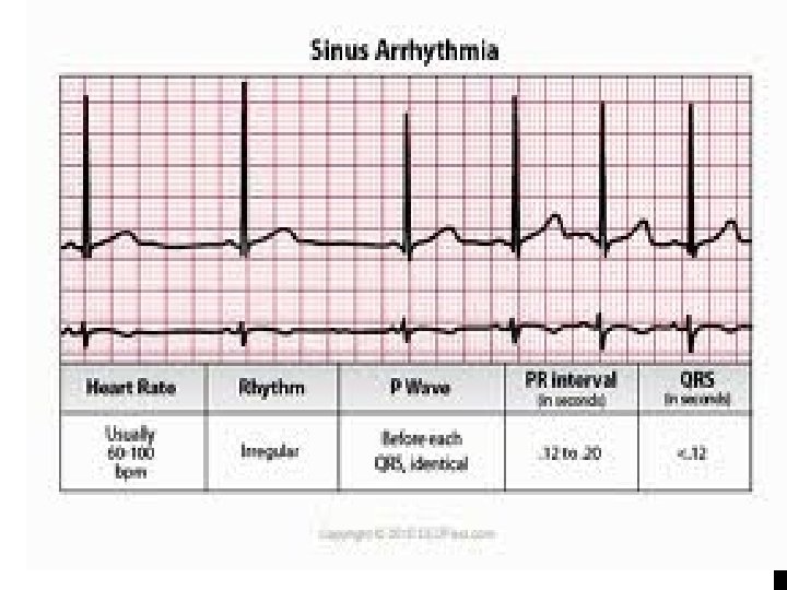 MECHANISMS OF CARDIAC ARRHYTHMIAS DR AMNA TAHIR PHYSIOLOGY