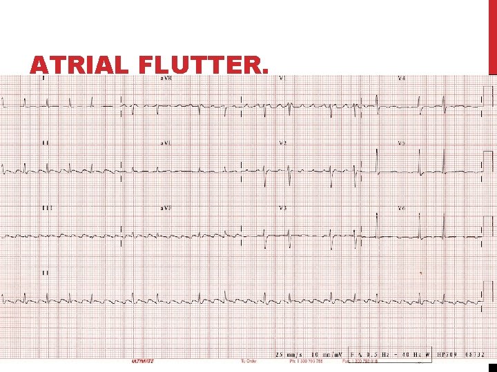 MECHANISMS OF CARDIAC ARRHYTHMIAS DR AMNA TAHIR PHYSIOLOGY