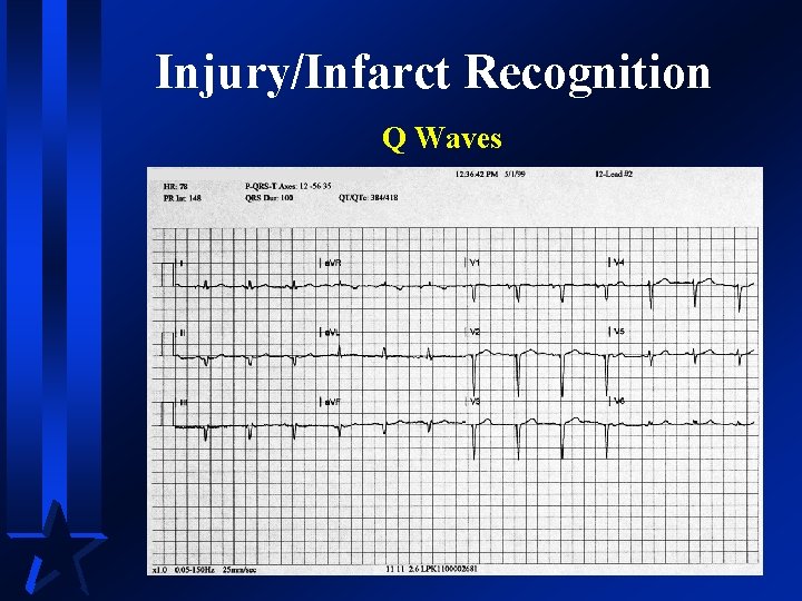 12 Lead ECGs Ischemia Injury Infarction Terry White
