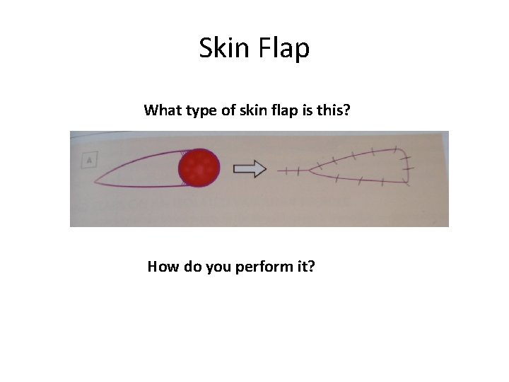 Skin Pathology Skin Flap What type of skin