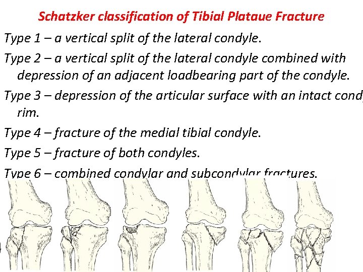 TIBIAL PLATEAU FRACTURES Mechanism of injury Fractures of