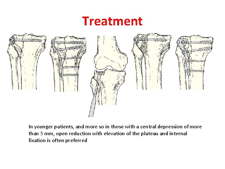 TIBIAL PLATEAU FRACTURES Mechanism of injury Fractures of