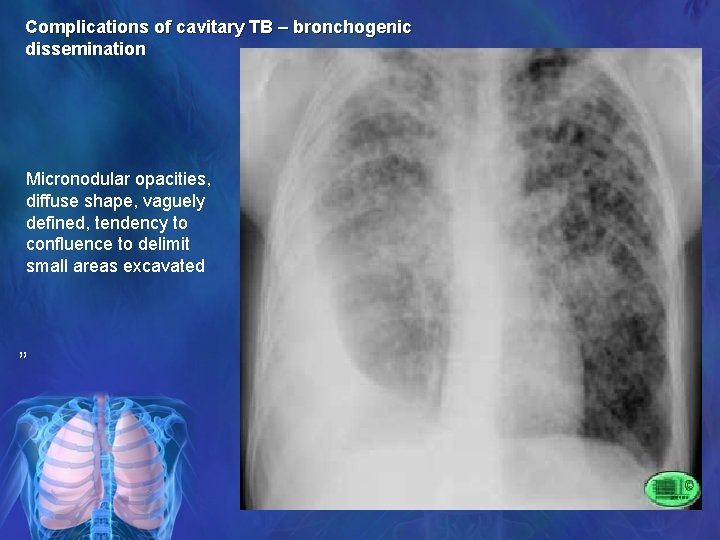 PULMONARY TUBERCULOSIS RADIOLOGICAL IMAGES Dr Miron Ramona Conf