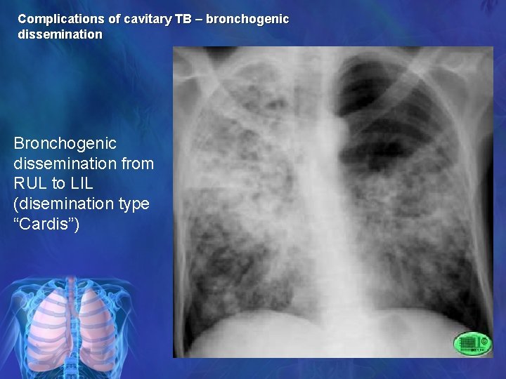 PULMONARY TUBERCULOSIS RADIOLOGICAL IMAGES Dr Miron Ramona Conf