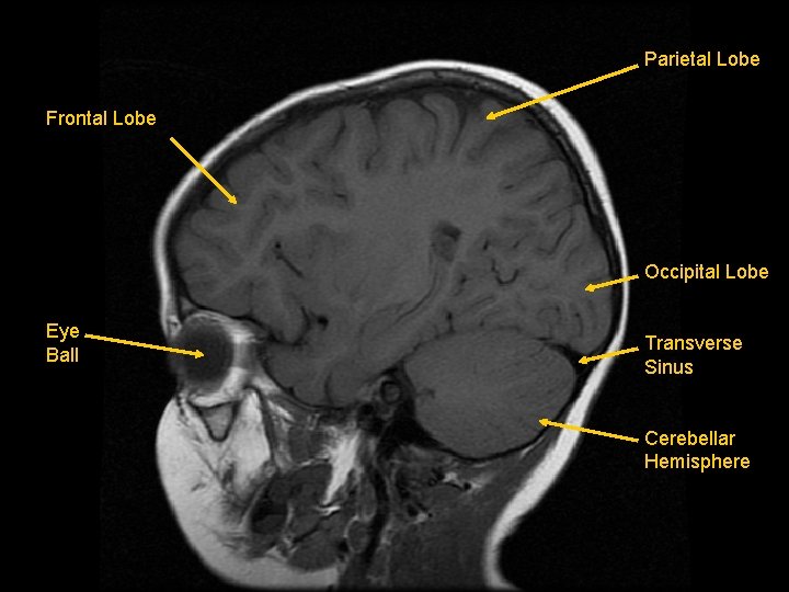 MRI of BrainHead and Neck labeling by Amanda