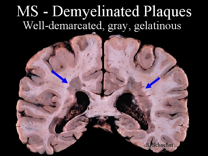 White Matter Lesions Marie Beckner MD 1 Idiopathic