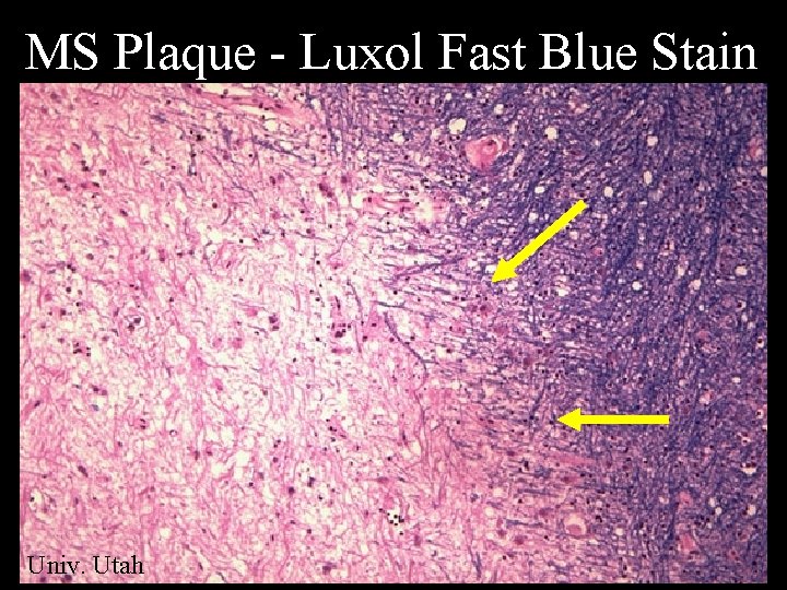 White Matter Lesions Marie Beckner MD 1 Idiopathic