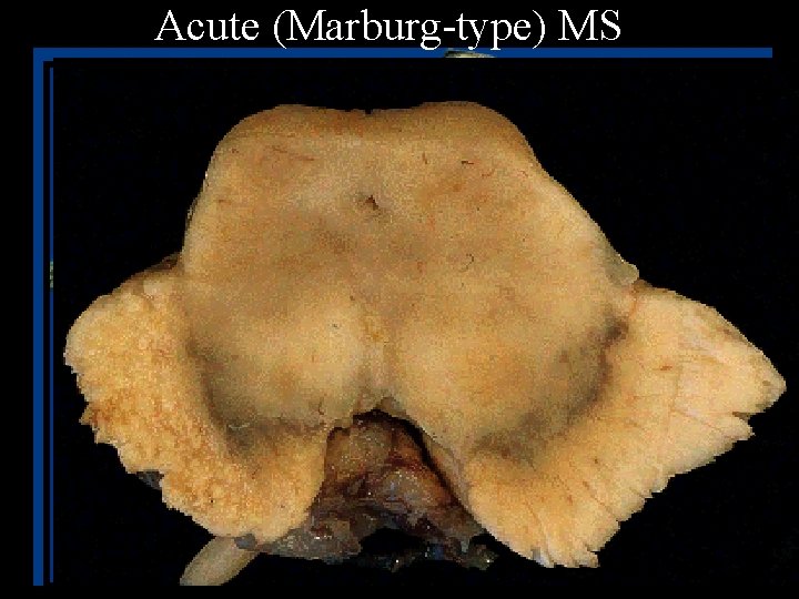 White Matter Lesions Marie Beckner MD 1 Idiopathic