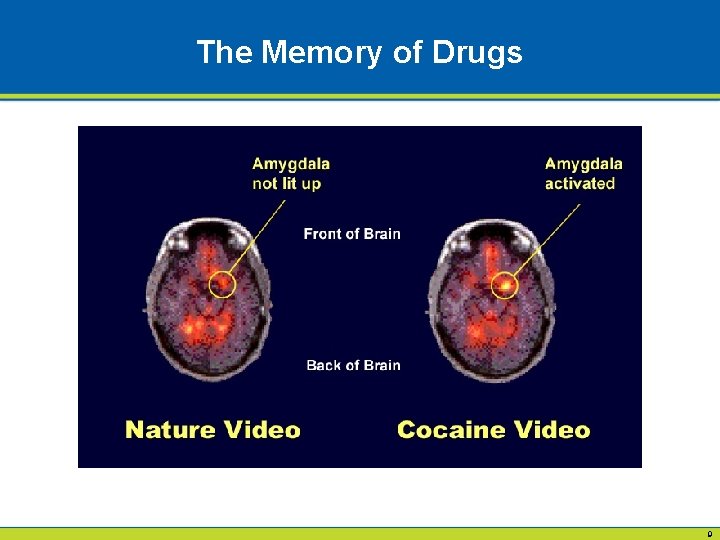 Opioid Dependence Highlighting Buprenorphine Treatment Tony Tommasello ...