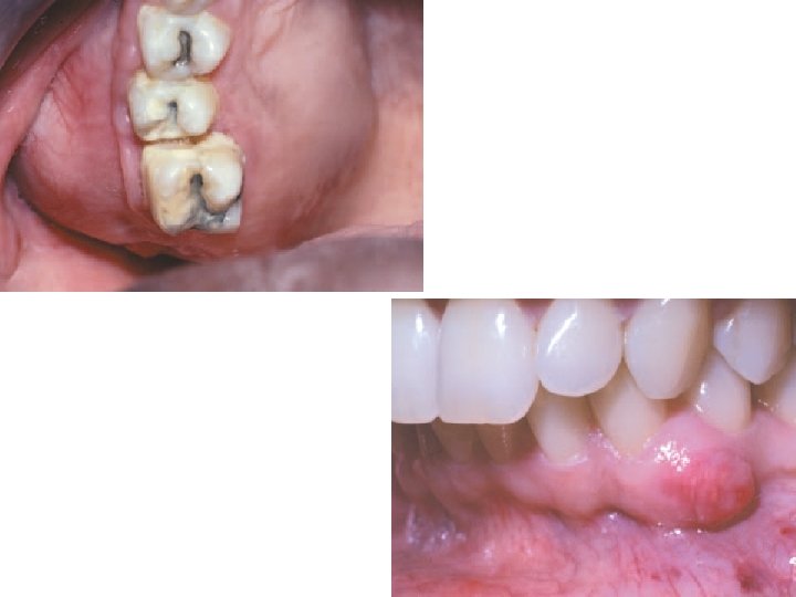 Treatment Treatment range from simple enucleation and curretage