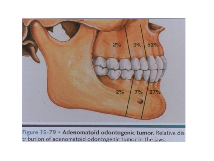 Treatment Treatment range from simple enucleation and curretage