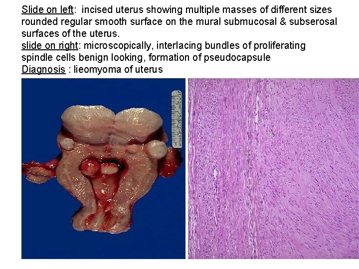 Finger like projections with central fibrovascular core covered