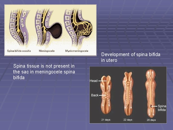 Spina Bifida Animal Science 434 Tuesday Lab Ashley