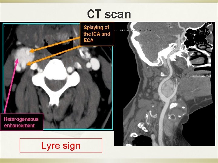 Carotid Body Tumor Joint Hospital Surgical Grand Round