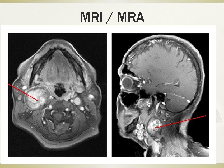 Carotid Body Tumor Joint Hospital Surgical Grand Round