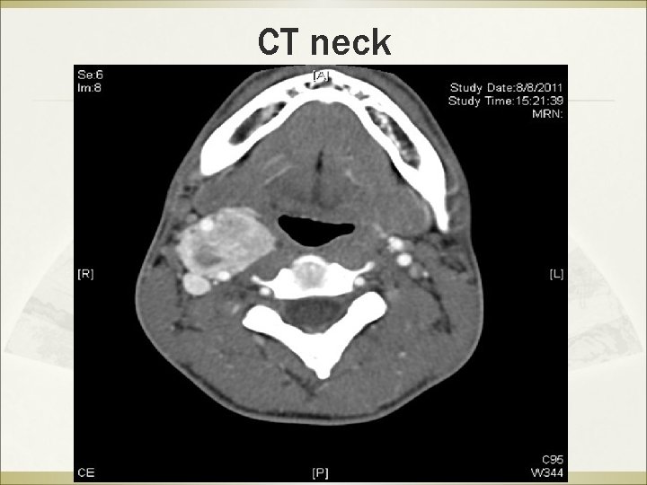 Carotid Body Tumor Joint Hospital Surgical Grand Round