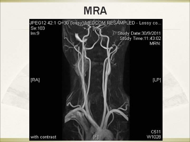 Carotid Body Tumor Joint Hospital Surgical Grand Round