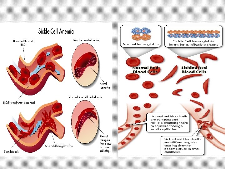 SICKLE CELL ANEMIA Omar and Yassin DEFINITION Sickle