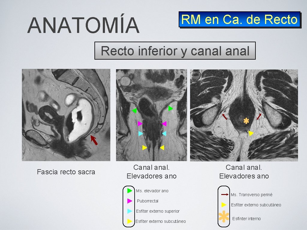 RM en Ca de Recto Tcnica Anatoma Interpretacin