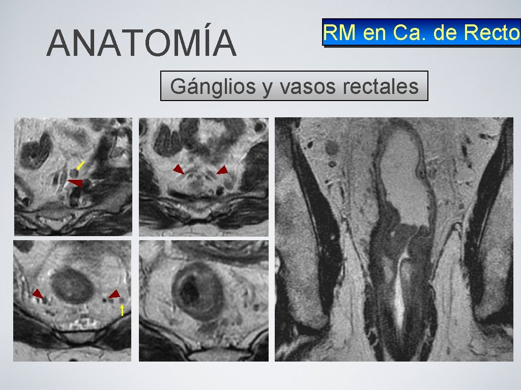 RM en Ca de Recto Tcnica Anatoma Interpretacin