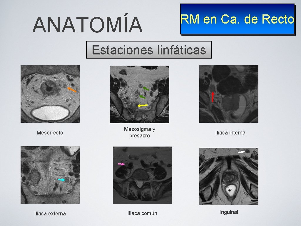 RM en Ca de Recto Tcnica Anatoma Interpretacin