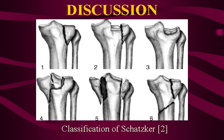 TIBIAL PLATEAU FRACTURE ROLE AND CONTRIBUTION OF MULTIDETECTOR