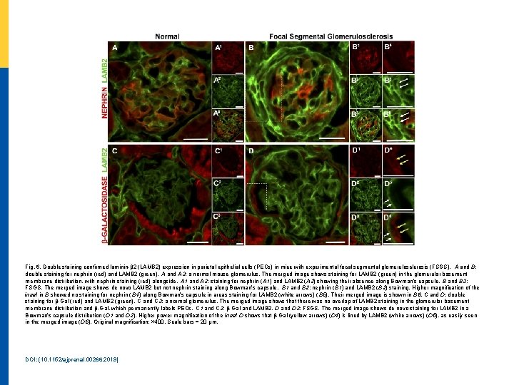 Fig 6 Double staining confirmed laminin 2 LAMB