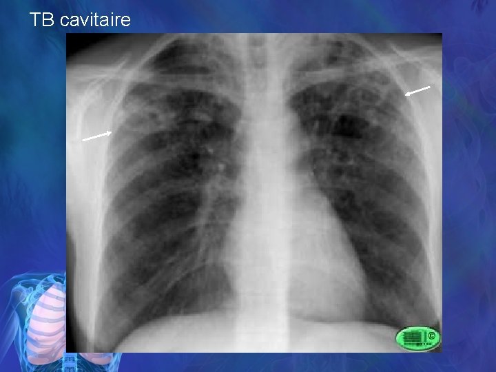 TUBERCULOSE PULMONAIRE ASPECTS EN RADIOLOGIE Dr Miron Ramona