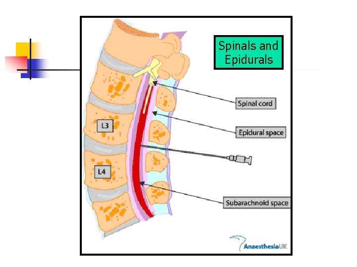 Obstetric Anaesthesia Physiological changes in pregnancy Mechanical ...