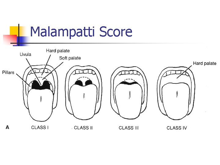 Obstetric Anaesthesia Physiological changes in pregnancy Mechanical ...