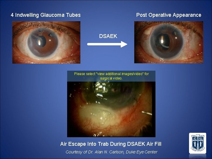 Prior incisional glaucoma surgery increases graft failure and