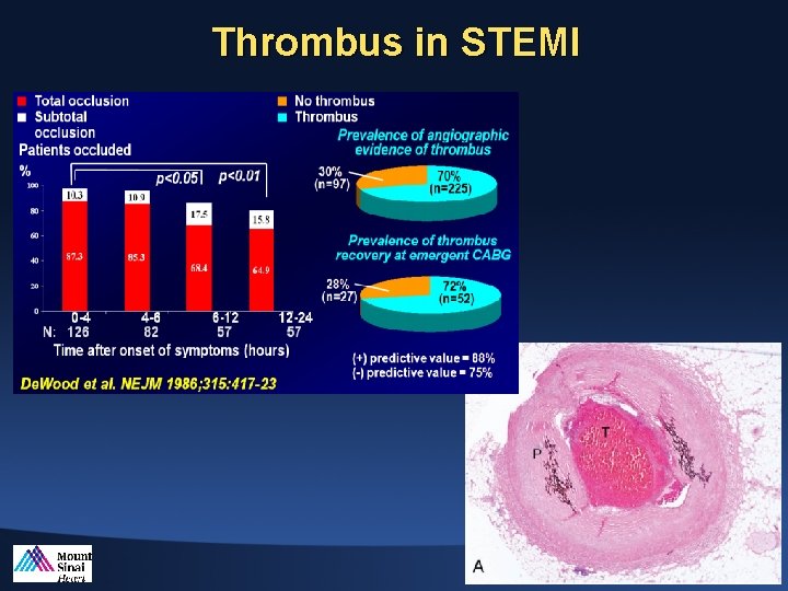 Thrombus management in the catheterization lab pharmacological options