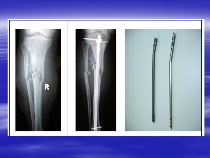 INDICATIONS FOR OPEN REDUCTIONS AND INTERNAL FIXATION OF